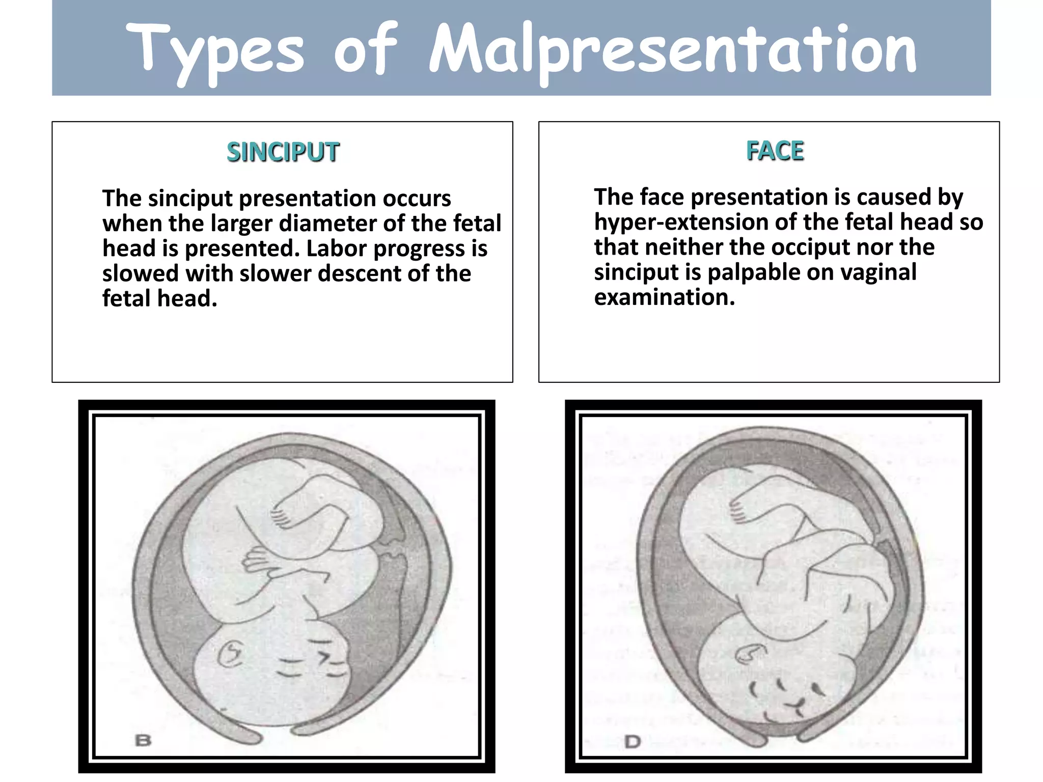 Malpresentation | PPT