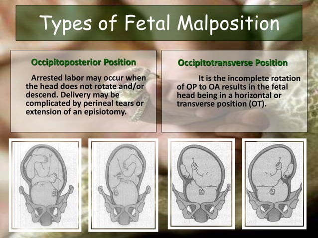 Malpresentation | PPT | Pregnancy | Reproductive Health