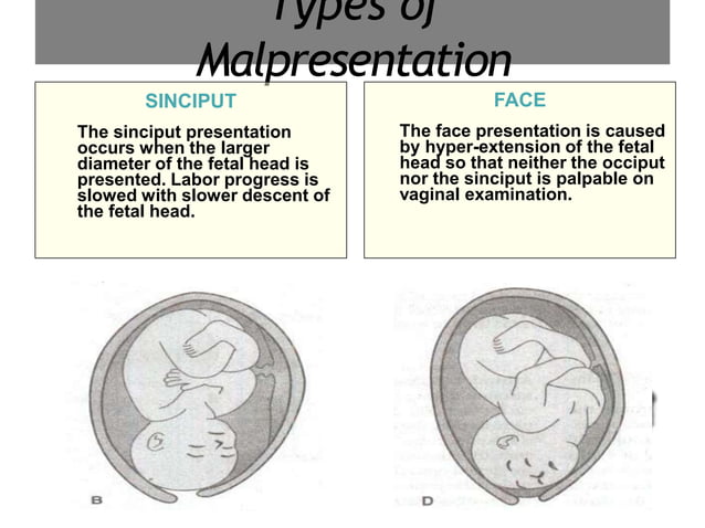 malpresentations | PPTX | Pregnancy | Reproductive Health