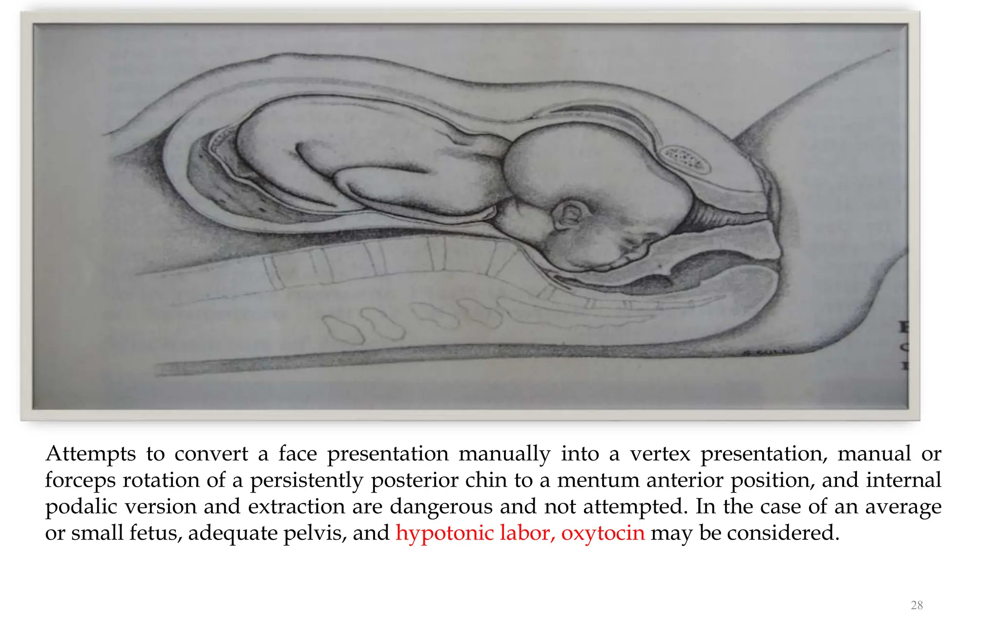 MALPRESENTATION AND MALPOnnnnnSITION.ppt