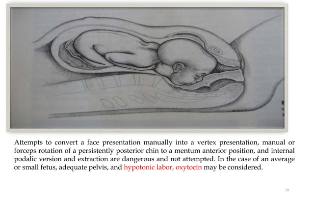 MALPRESENTATION AND MALPOnnnnnSITION.ppt