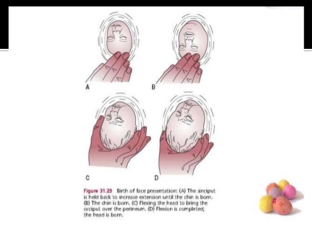 Malpresentation (face, brow)