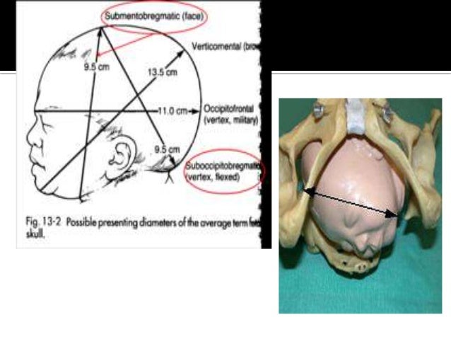 Brow Presentation Diameter