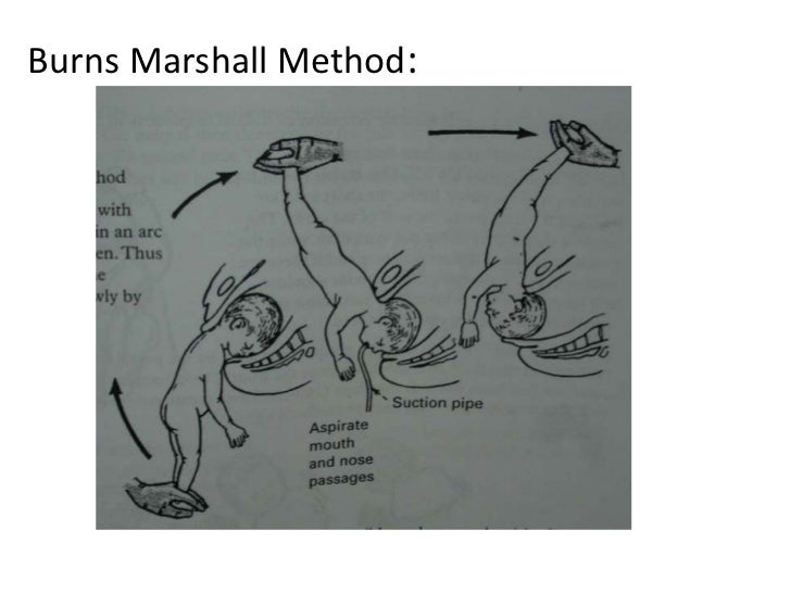 Malpresentation illi(2)