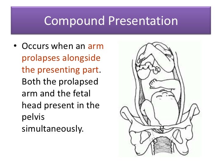 Malpresentation illi(2)