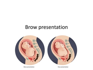 Malpresentations | PPTX