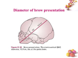 Brow Presentation Diameter