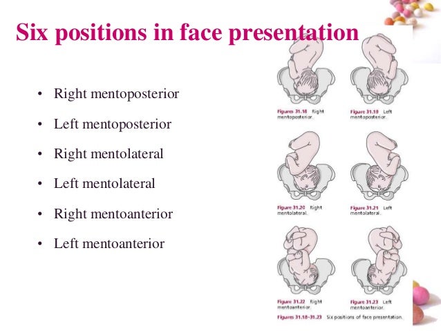 Face Presentation Mentum Posterior Sonographic Evaluation Of The Fetal