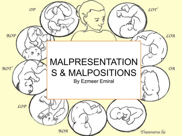 Malpresentations&malpositions | PPTX
