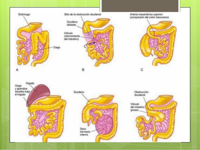 Cirugía Pediátrica - Malrotación intestinal