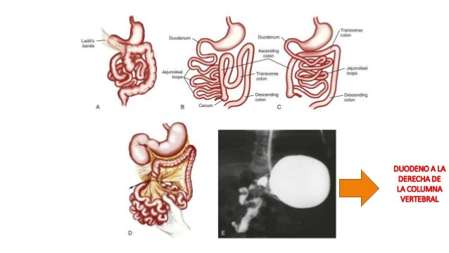Malrotacion intestinal-cirugia pediatrica