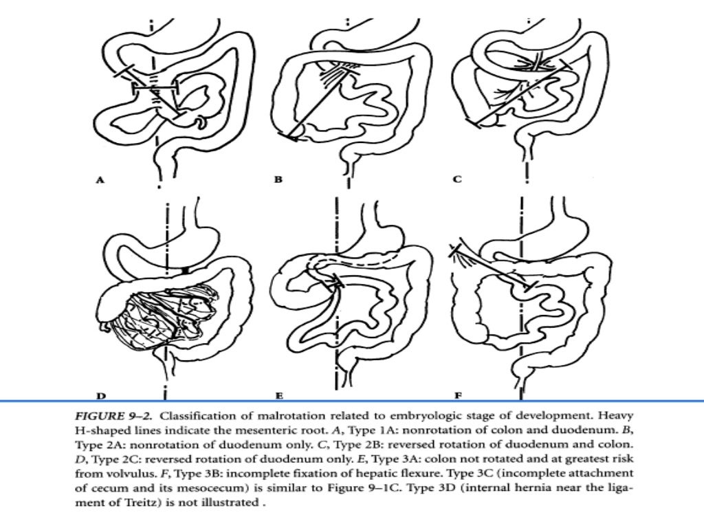 Malrotation
