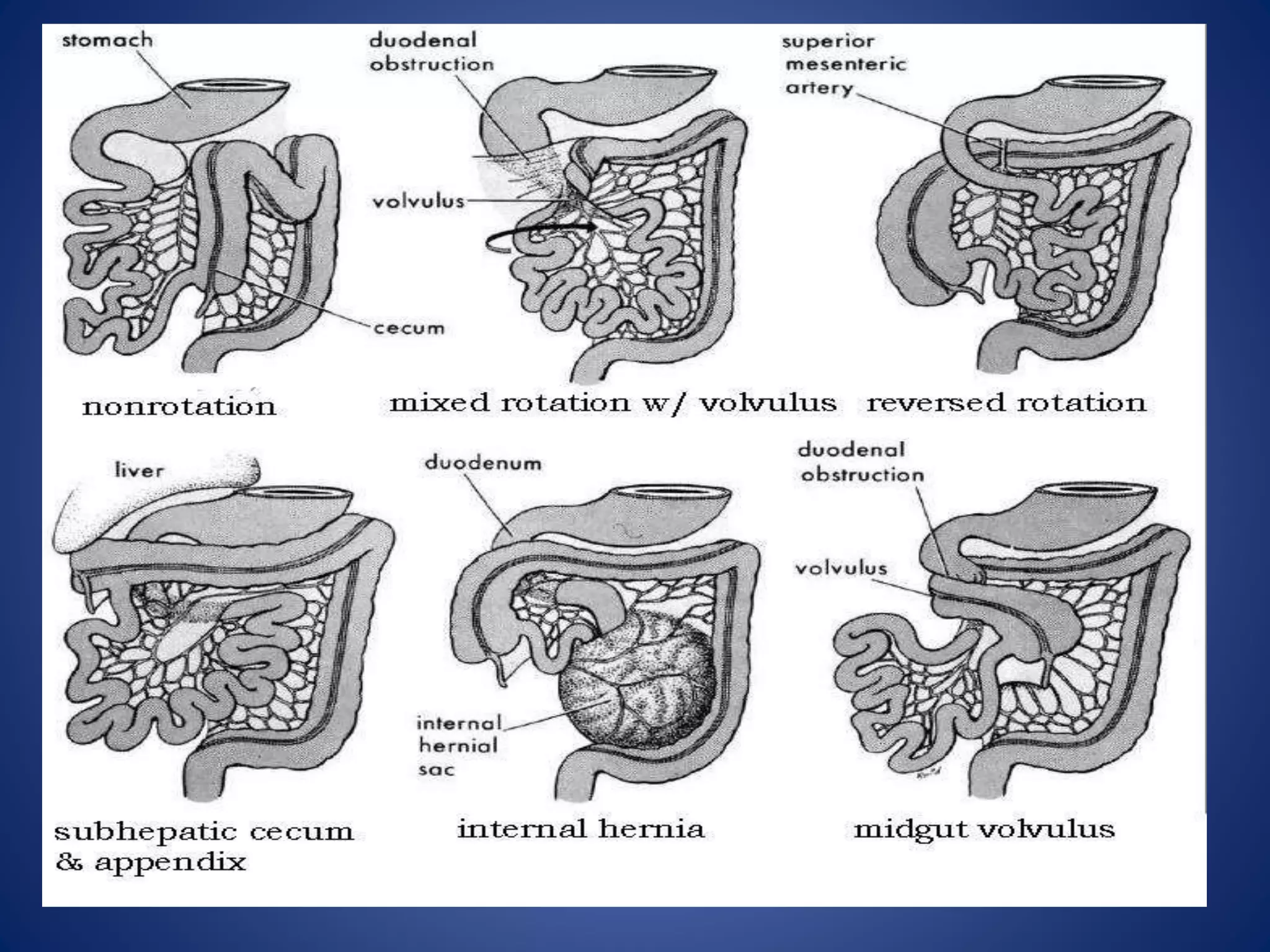 Malrotation of gut | PPTX