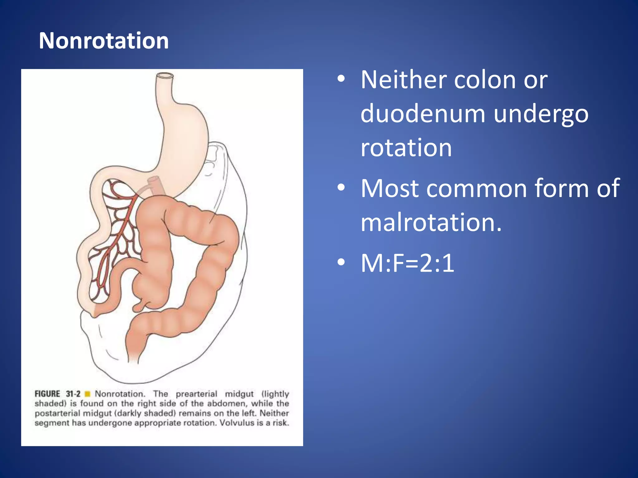 Malrotation of gut | PPTX