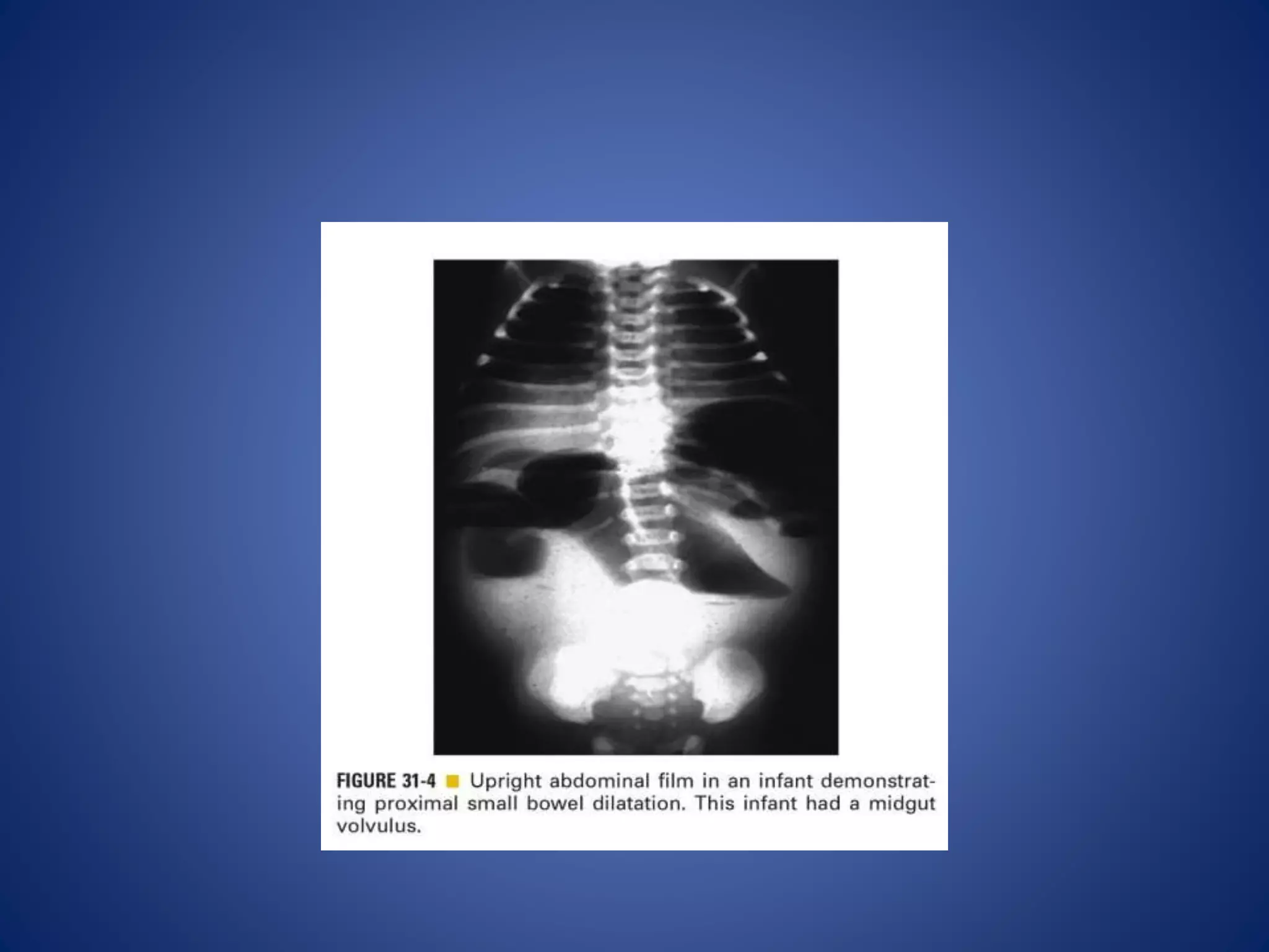 Malrotation of gut | PPTX