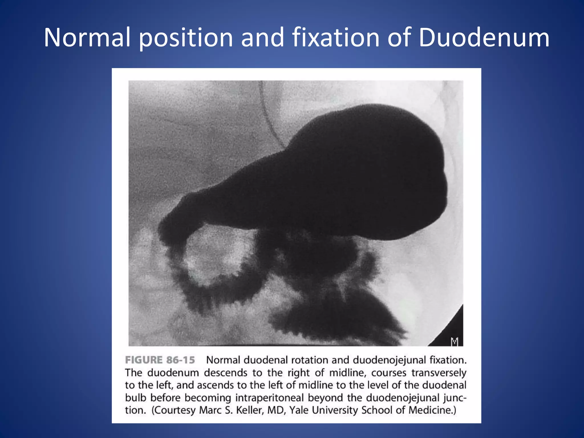 Malrotation of gut | PPTX