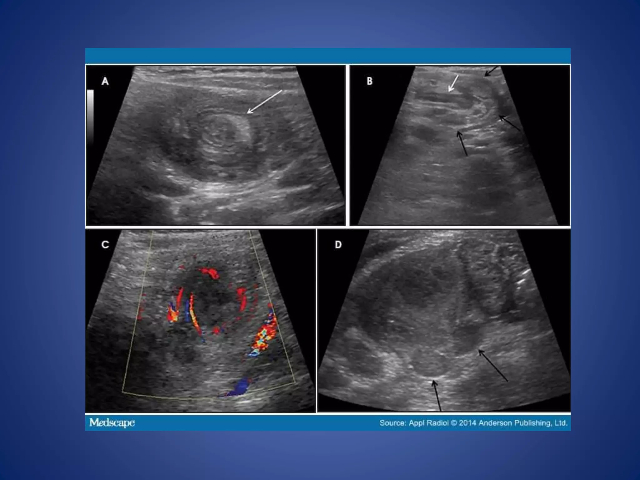 Malrotation of gut | PPTX