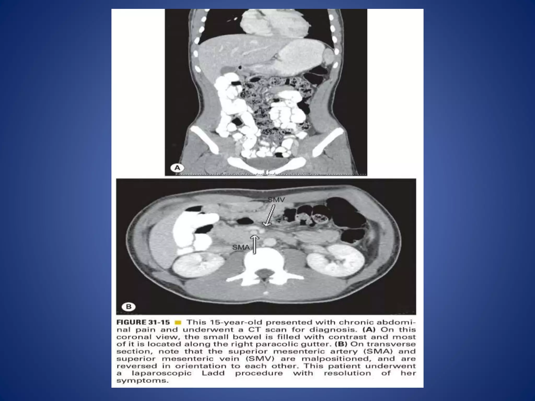 Malrotation of gut | PPTX