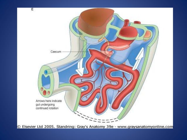 Malrotation of gut | PPTX | Digestive Disorders | Diseases and Conditions