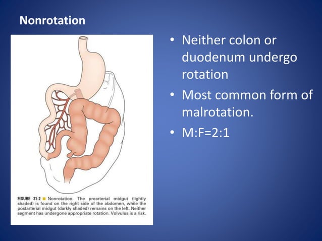 Malrotation of gut | PPTX | Digestive Disorders | Diseases and Conditions