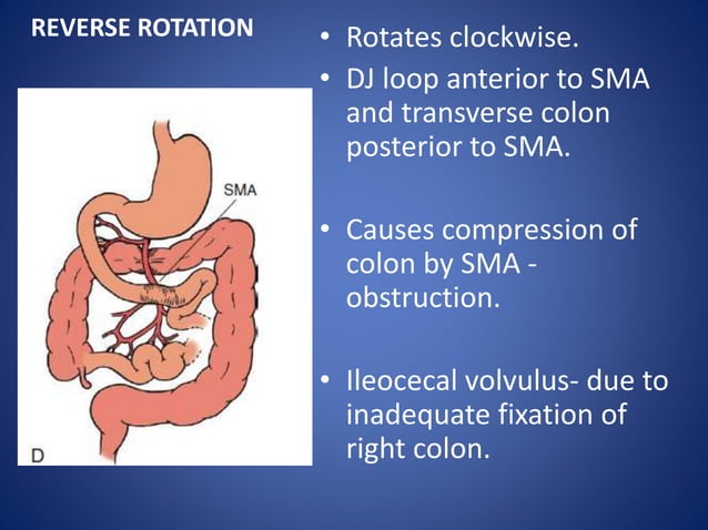 Malrotation of gut | PPTX | Digestive Disorders | Diseases and Conditions
