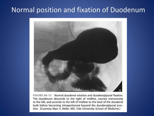 Malrotation of gut | PPTX | Digestive Disorders | Diseases and Conditions