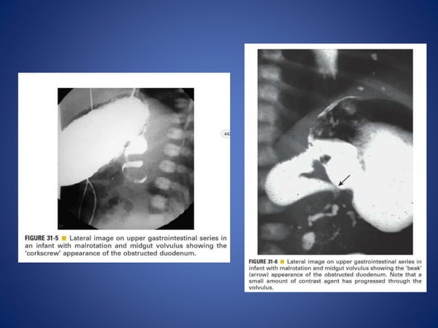 Malrotation of gut | PPTX | Digestive Disorders | Diseases and Conditions