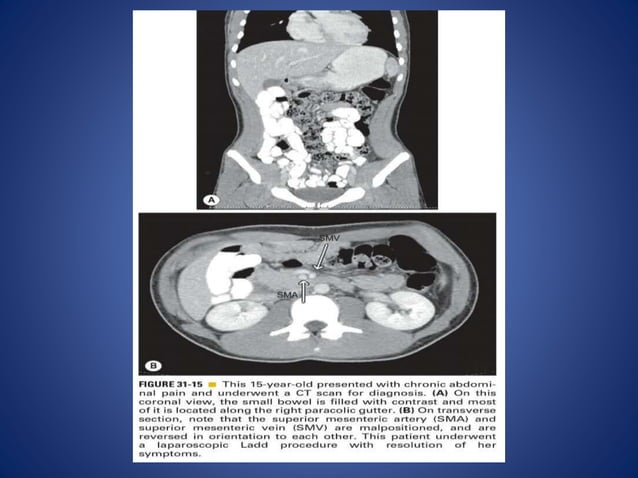 Malrotation of gut | PPTX | Digestive Disorders | Diseases and Conditions