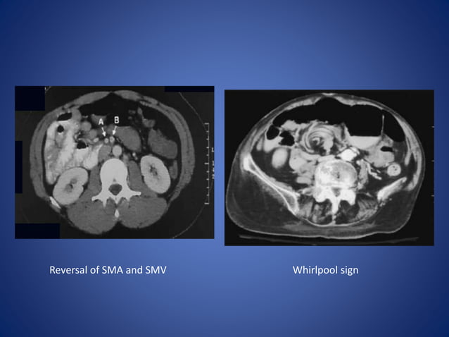 Malrotation of gut | PPTX | Digestive Disorders | Diseases and Conditions