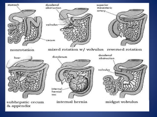 Malrotation of gut | PPT