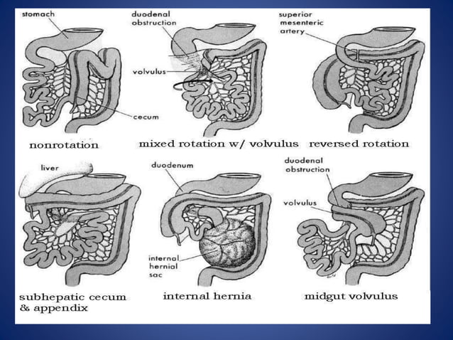 Malrotation of gut