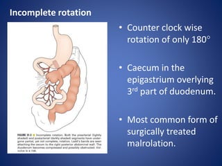Malrotation Embryology