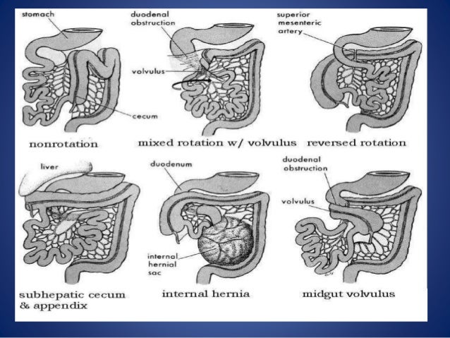 Malrotation of gut