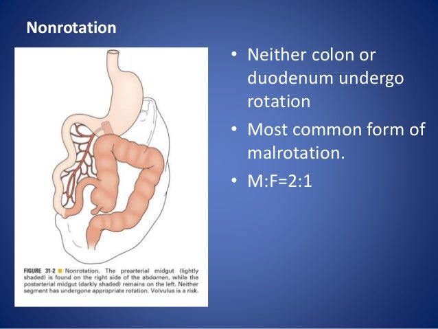 Malrotation of gut