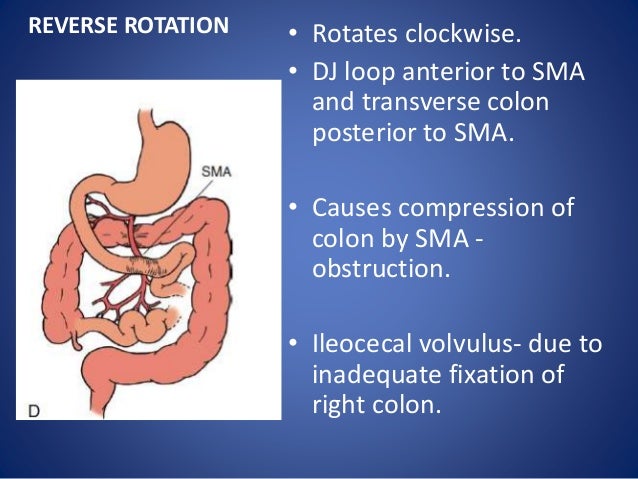 Malrotation of gut