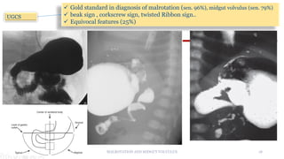 MALROTATION & MIDGUT VOLVULUS final.pdf