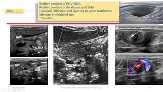 MALROTATION & MIDGUT VOLVULUS final.pdf