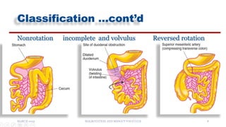 MALROTATION & MIDGUT VOLVULUS final.pdf