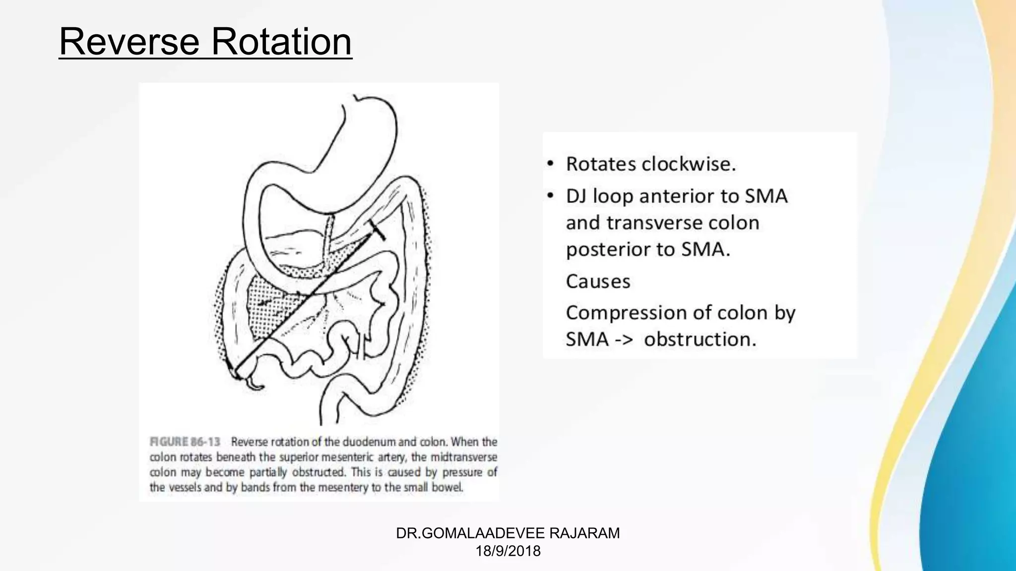 Malrotation with midgut volvulus.pptx
