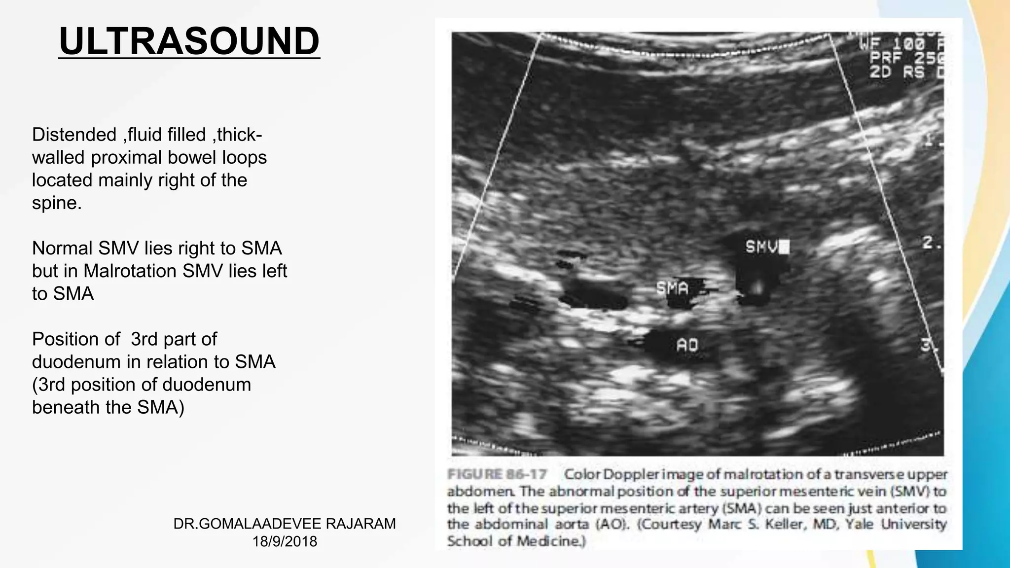 Malrotation with midgut volvulus.pptx
