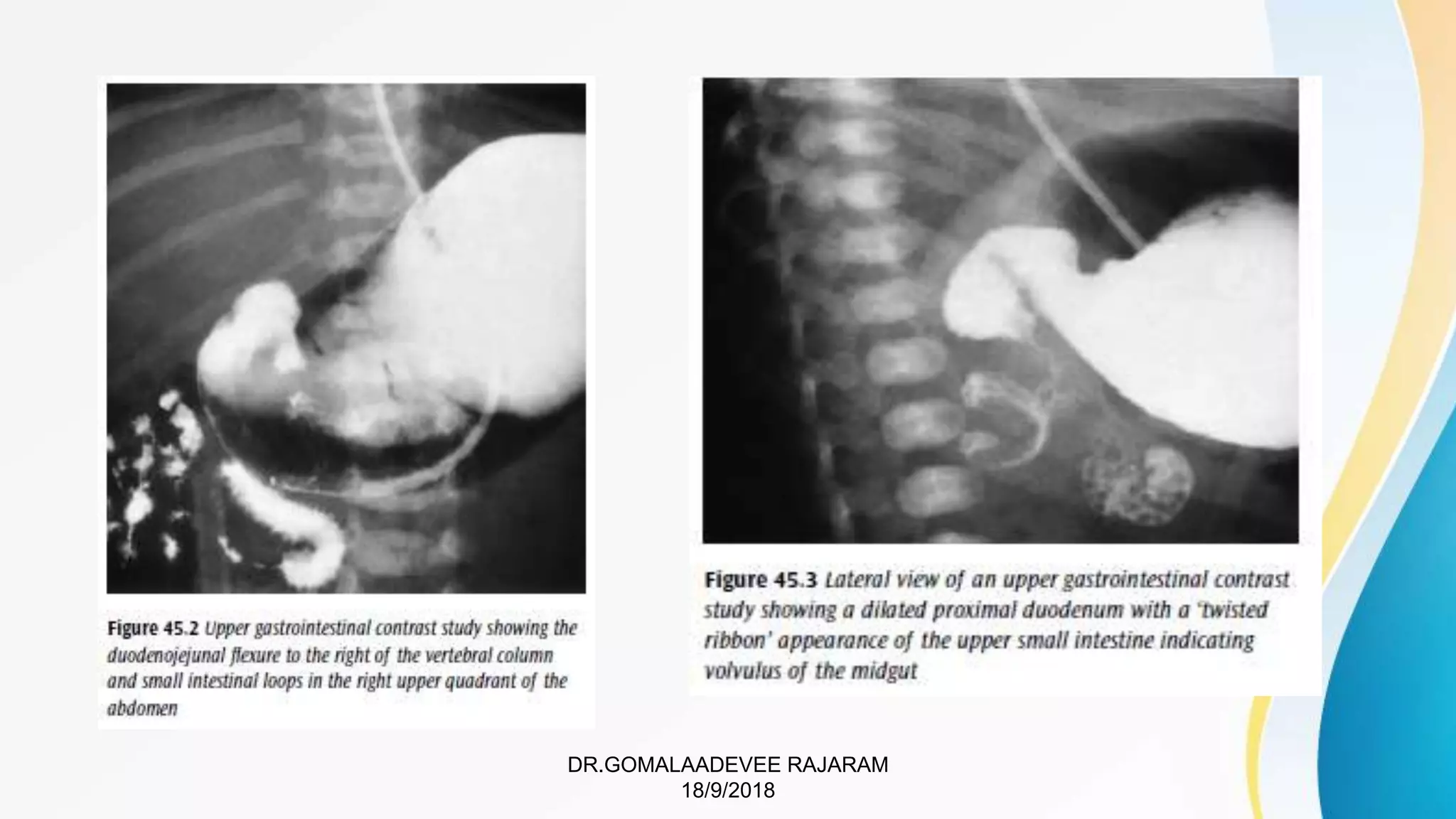 Malrotation with midgut volvulus.pptx