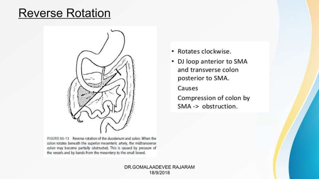 Malrotation with midgut volvulus.pptx | Digestive Disorders | Diseases ...