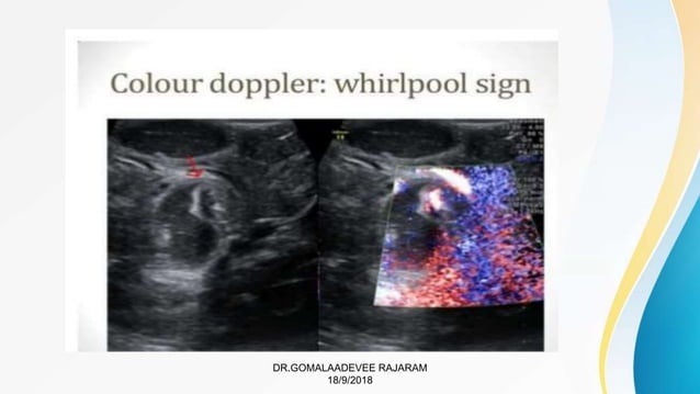 Malrotation with midgut volvulus.pptx | Digestive Disorders | Diseases ...