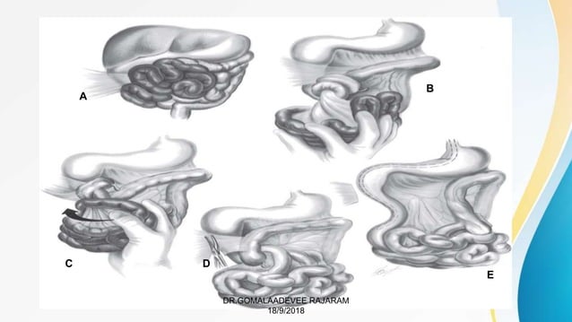 Malrotation with midgut volvulus.pptx | Digestive Disorders | Diseases ...
