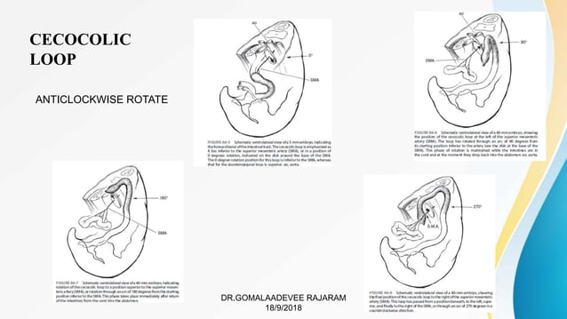 Malrotation with midgut volvulus.pptx | Digestive Disorders | Diseases ...