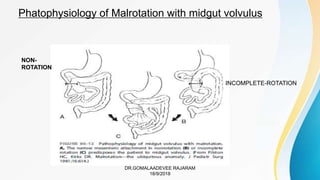 Malrotation with midgut volvulus.pptx