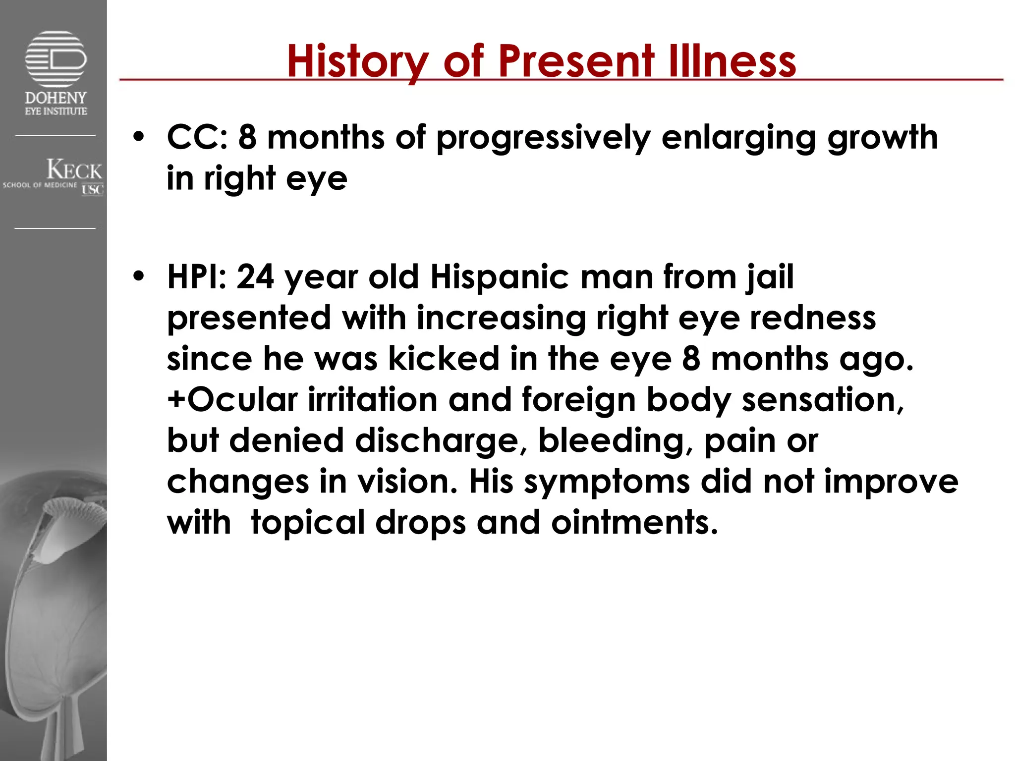 Conjunctival MALT Lymphoma | PPT