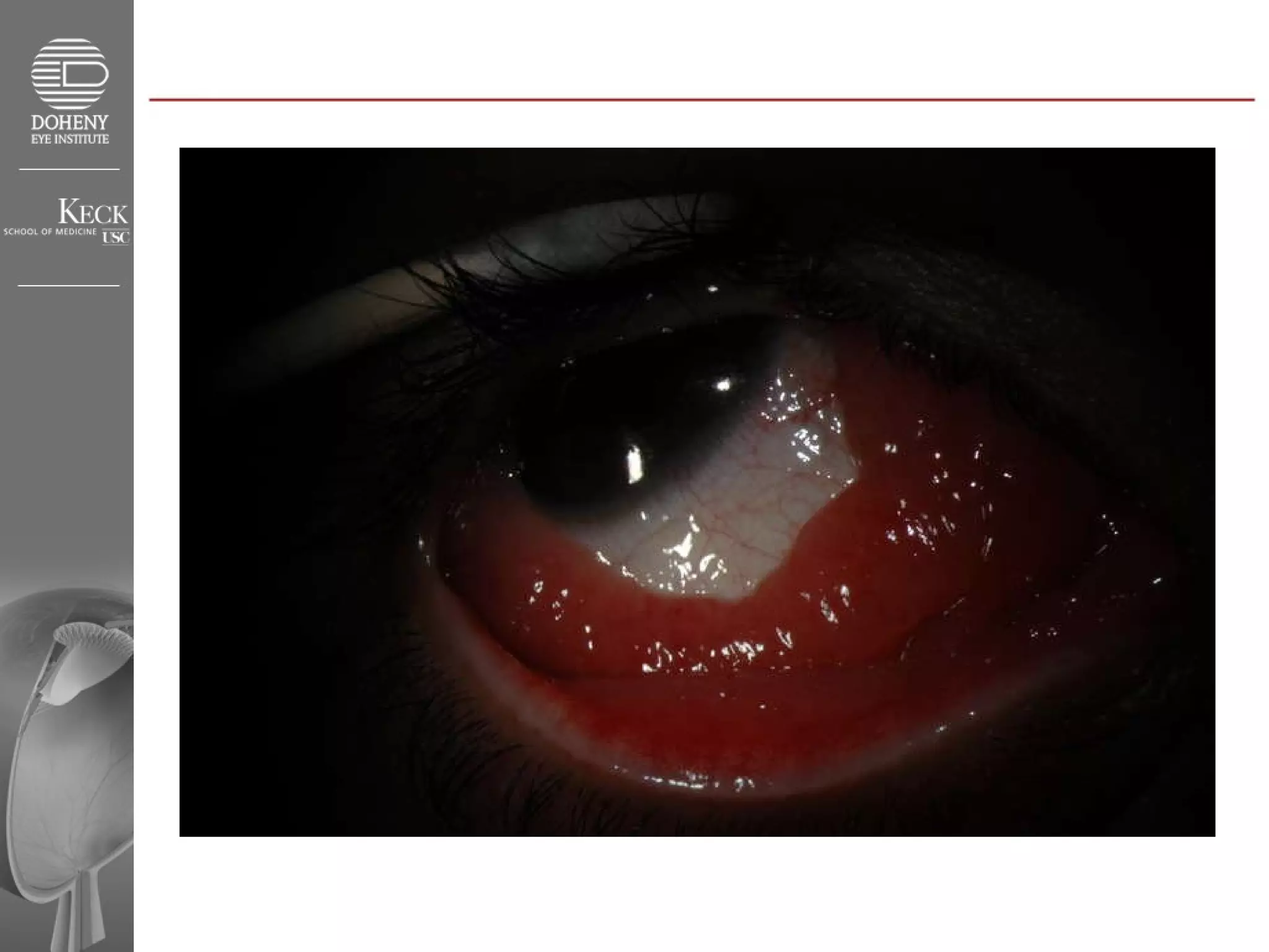 Conjunctival MALT Lymphoma | PPT