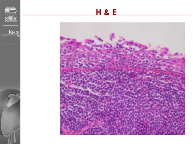 Conjunctival MALT Lymphoma | PPT | Eye and Vision Conditions | Diseases ...