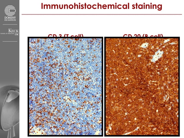 Conjunctival MALT Lymphoma | PPT | Eye and Vision Conditions | Diseases ...